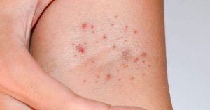 Points rouges sur la peau : Le lien entre pétéchies et leucémie