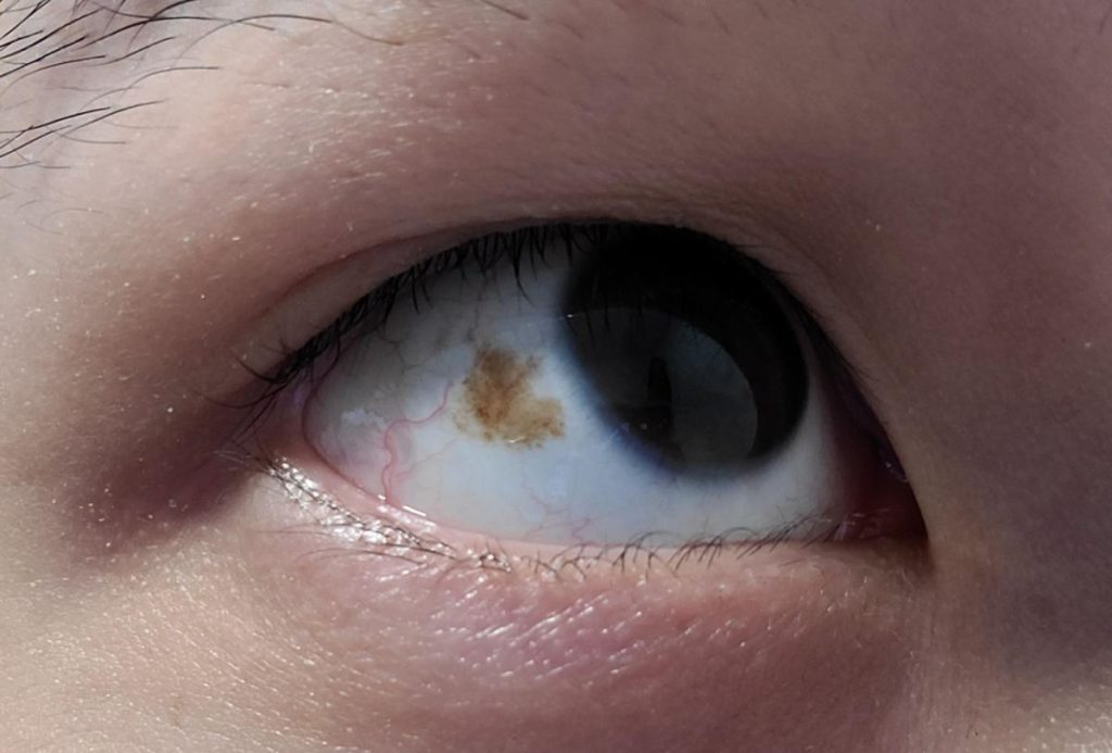 Comment se débarrasser d'un kyste ? Types, remèdes maison...